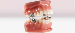 MARA instructions | How to correct your jaw with a MARA appliance ...